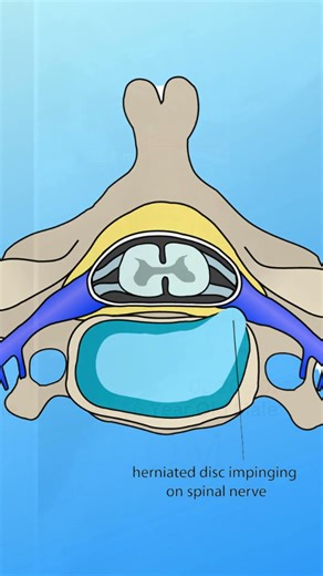 This is why your arm is burning #cervicalradiculopathy #discbulge #pinchednerve #chiropracticcare