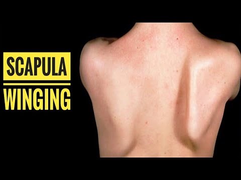 Winging of Scapula