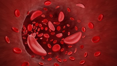 ‘Stiff’ Cells Provide New Explanation for Differing Symptoms in Sickle Cell Patients | Newswise