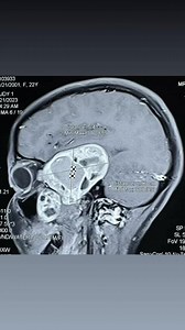“Keyhole concept” DX: Trigeminal Schwannoma with infratemporal extension. Incision: 6cm vertical incision starting from tragus. Approach: Temporal mini craniotomy(3cm 3cm) Peroperative: Lumber drain used Postoperative: no complications. | Isma Azam Zico