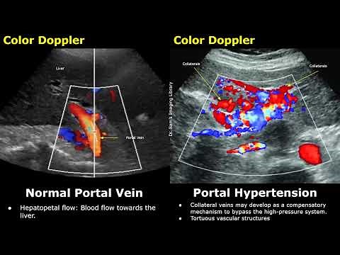 Portal Vein Color & Spectral Doppler Ultrasound Normal Vs Abnormal Images | Liver Vascular USG Scan
