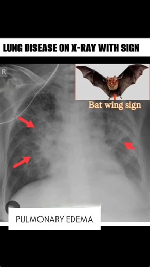 RK NURSE'S HUB on Instagram: "The "bat sign" or bat-wing appearance on a chest X-ray refers to symmetrical, dense opacities radiating from the heart (hilum) outwards, resembling a bat's outstretched wings, classic for acute pulmonary edema (fluid in lungs) from heart failure, but can also signal conditions like severe pneumonia, hemorrhage, or inhalation injury. It's caused by fluid filling the central lung air sacs (alveoli), appearing opaque, with the periphery often spared due to better lymph