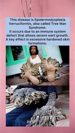 Tree Man Syndrome Explained #TreeManSyndrome #RareDisease