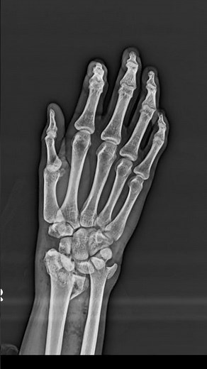 displaced fracture of distal radius and styloid process of ulna seen