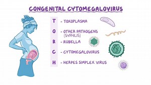 Video: Congenital cytomegalovirus (NORD) - Video Explanation! | Osmosis | Osmosis