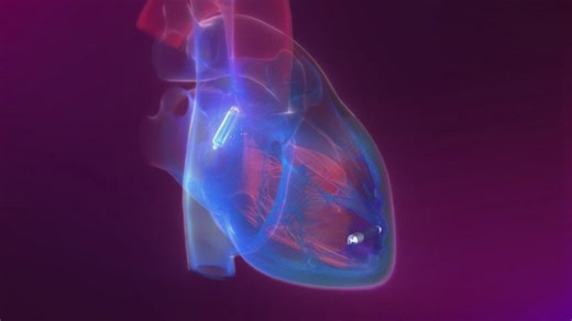 UnityPoint Trinity performs Quad Cities’ first leadless pacemaker procedure