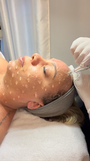 Micro needling Facial boost 400% more Collagen! By age 40, most people lose about 1% of collagen per year — microneedling helps your skin turn back the clock naturally by boosting collagen up to 400% over time. ⏳#symphonyspaandyoga #selfcare #symphonyspa #kingstondayspa #ygkwellness #spaday #ygk #kingstonontario #kingstonon | Symphony Spa & Yoga | Facebook