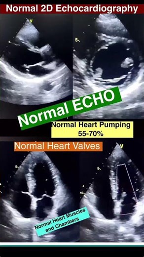 Normal 2D Echocardiogram #echo #shorts