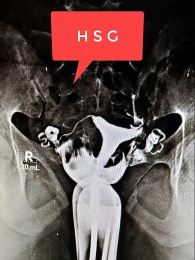 Hysterosalpingography (HSG)