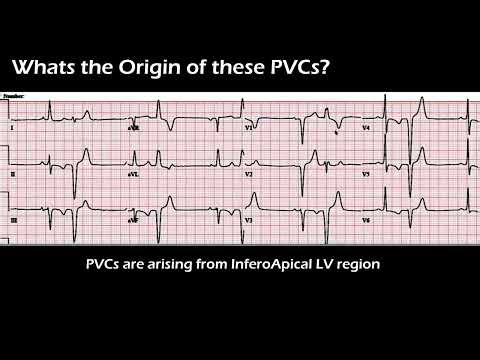 PVCs arising from Inferoapical Left Ventricle #ECG