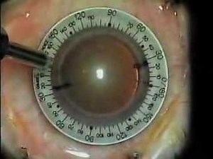 AcrySof Toric IOL Marking by Warren Hill, MD