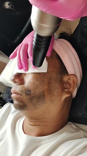 443K views · 1.8K reactions | Hollywood CARBON LASER FACIAL TREATMENT...