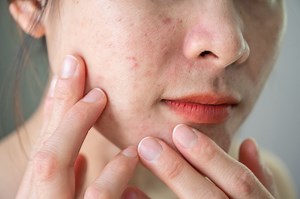 Dermatologist warns 'holistic' acne tool people are swearing by has 'limited evidence'