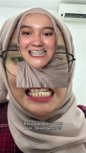 Sebelum ganti tahun, mau review progress behel selama 2025 (April - Desember). Semoga tahun depan udah lebih rapiii! #beheljourney #underbite #crossbite #orthodontics #behelgigi