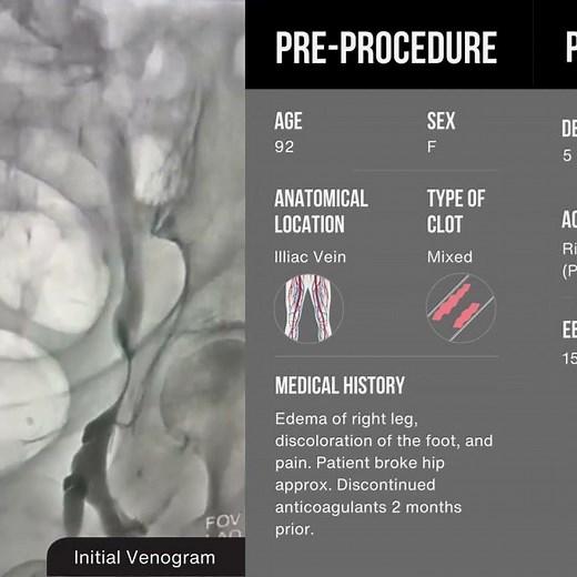 Iliac Vein Venous Thrombosis | Symphony™ Thrombectomy System