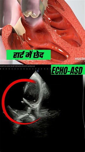 हार्ट में छेद इस तरह दिखता है -Actual View of a Hole in the Heart#animation#hhearthole