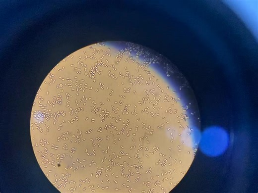 67K views · 818 reactions | Sickling test (positive)❣️ | Lab life | Facebook