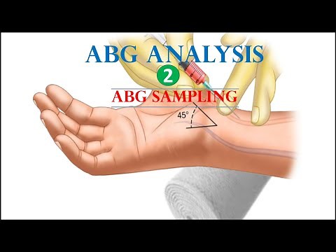 Arterial blood Gas Analysis (ABG sampling)