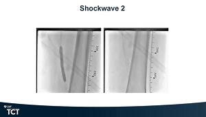 Meet the Experts: Cracking Subintimal SFA Calcium with Shockwave IVL with Dr. Sahil Parikh