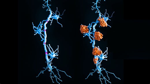 Multiple Sclerosis May Have Two Distinct Subtypes, Scientists Discover