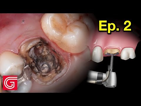 HOW TO Remove OLD Amalgam Restoration | Ep 2