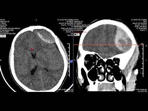 Extra-Dural bleeding in brain . How to calculate EDH ( BLEED VOLUME ) on CT SCAN