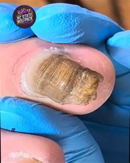 13K views · 94 reactions | Best Nail Practices for Nail Pain With Lasting Results #CleanNailsDaily #NailCareTips #HealthyNails #ToenailRoutine | NC State Wolfpack on TheWolfpacker.com | Facebook