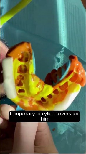 Creating a Dental Bridge #dentist #cosmetics #dental