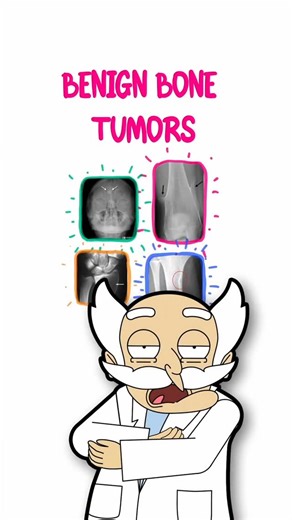 Study Smarter with MedSchoolBro on Instagram: "Vote in the poll below 👇 🧒 Benign = many start with “O.” Osteochondroma: Most common benign; boys under 25; lateral bony outgrowth with cartilage cap. Osteoid osteoma: Night pain relieved by NSAIDs. Osteoma: Linked to Gardner syndrome. Chondroma: Benign cartilage tumor (hands/feet common). Giant cell tumor: Ages 20–40, epiphysis, “soap-bubble” on X-ray. ⚠️ Malignant Osteosarcoma: Painful enlarging mass; sunburst or Codman triangle; teens or older 