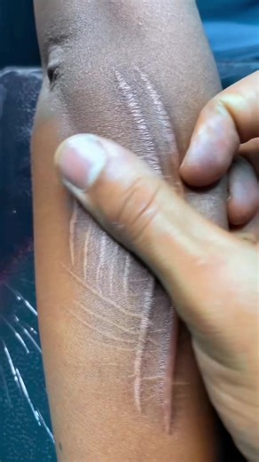 original tcm scar removal gel #scar #scarjel #tcmscarjel #yetebasamatfiya #scarremoval