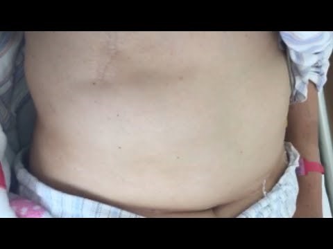 Hiccups caused by a Cardiac Device