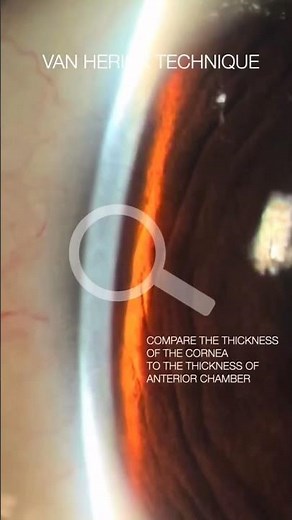 Van Herick Technique