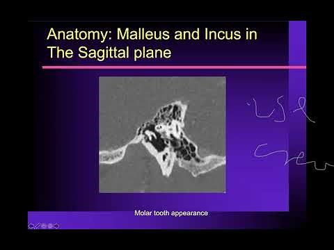 CT & MRI Imaging of the Temporal Bone