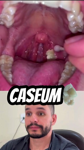 O que são cáseos amigdalianos e como tratá-los?