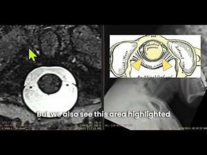 Patient Gets Symptoms with Looking Down or a Split Tear in the Transverse Ligament