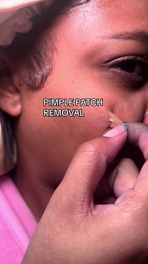 Removing Pimple Patches with PanOxyl: A Step-by-Step Guide