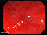 Colonoscopic Polypectomy (1 of 23) • Video • MEDtube.net