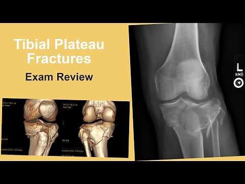 Tibial Plateau Fractures Exam Review - Brian Weatherford, MD