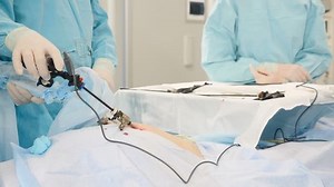 Laparoscopic cholecystectomy instrument. Real Surgery, abdominal incision, working with surgical laparoscopy instruments. Doctor hands in sterile gloves holding trocar for laparoscopy procedure. 4 k