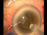 Results of phacoemulsification after microtrack filtration operation-a one minute glaucoma procedure • Video • MEDtube.net