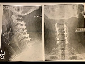 2 MONTH POST SURGERY: POSTERIOR CERVICAL DECOMPRESSION AND FUSION C2-C6 - NECK SURGERY