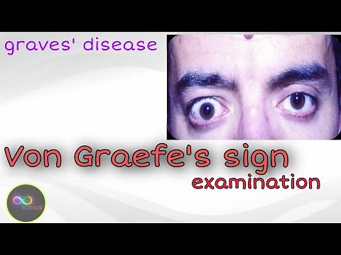 Von Graefe's sign|graves disease|hyperthyroidism|pseudo von Graefe's sign
