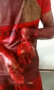 Man Hand Cut After Being Attacked With Machete