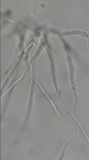 Fungal Hyphae in KOH Mount of Sputum | Microscopic View of Fungal Infection