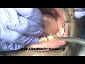Hidden dental root stump removal and implants placement IMPLANT SURGERY VIDEO