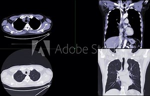 multi view of CT Chest with Contrast or CTA pulmonary artery after injection contrast media agent for diagnosis pulmonary embolism and lung disease.