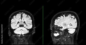 The MRI brainT2 flair sequence scan footage reveals intricate brain details, aiding in diagnostic procedures.