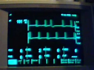 arrhythmic ECG / EKG with auscultation heartbeat sound