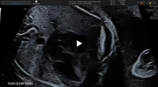 Rare fetal heart defect diagnosed with Voluson | Long Bạch Hải posted on the topic | LinkedIn