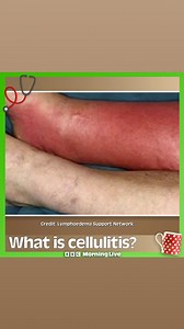 176K views · 226 reactions | 喙 Here’s an explainer of what cellulitis is, the symptoms of it and what to do if you or someone you know has it, with Dr Ranj. To watch this in full search for Morning Live on iPlayer from 06/02/25. #Cellulitis | BBC Morning Live | Facebook